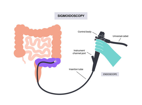 「Sigmoidoscopy」の写真素材 | 252件の無料イラスト画像 | Adobe Stock