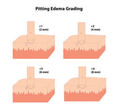 "Pitting Corrosion" Bilder – Durchsuchen 9,235 Archivfotos ...