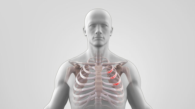 Rippenbruch-Bilder: Stock-Fotos & -Videos. | Adobe Stock