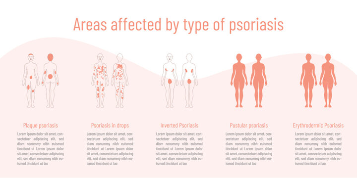 Psoriasis Types Images – Browse 860 Stock Photos, Vectors, and Video ...