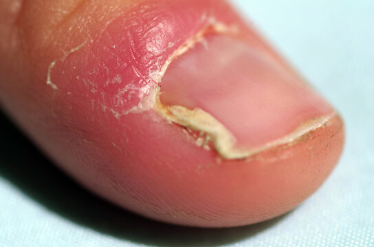 "Nail Diseases" Images – Browse 1,088 Stock Photos, Vectors, and Video ...