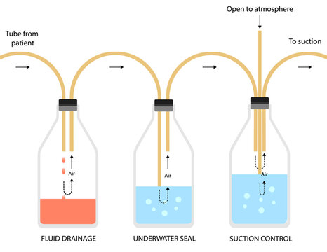 "Chest Tube" Images – Browse 112 Stock Photos, Vectors, and Video ...