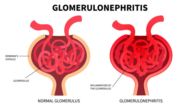 รูปภาพGlomeruli – เลือกดูภาพถ่ายสต็อก เวกเตอร์ และวิดีโอ1,363 | Adobe Stock