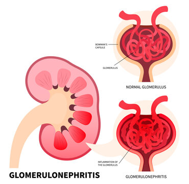 รูปภาพGlomeruli – เลือกดูภาพถ่ายสต็อก เวกเตอร์ และวิดีโอ1,363 | Adobe Stock