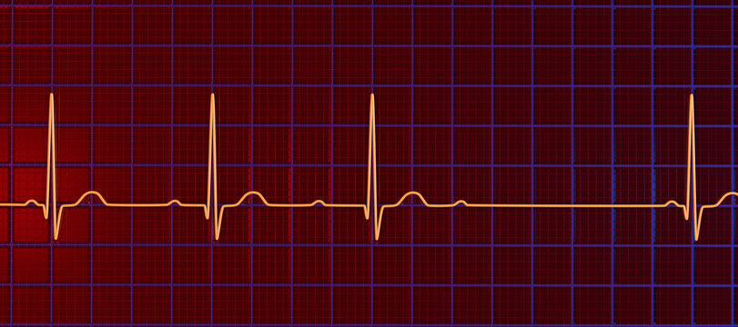 Wenckebach Ekg