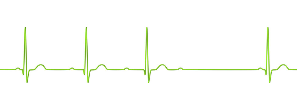 Wenckebach Block Second Degree AV Block Type 1 (wenckebach)