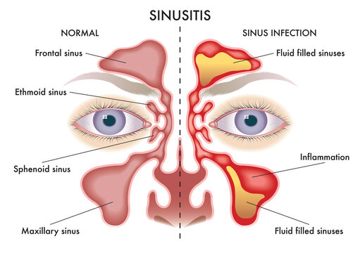 Sphenoid Sinus Images Browse 211 Stock Photos Vectors and Video Adobe Stock