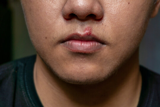 "Blisters Crust" Images – Browse 108 Stock Photos, Vectors, and Video ...