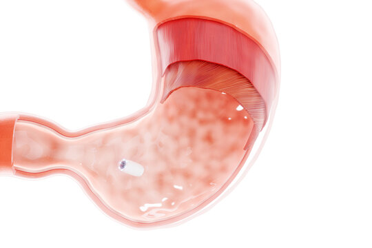"Capsule Endoscopy"-Bilder: Stock-Fotos & -Videos. | Adobe Stock