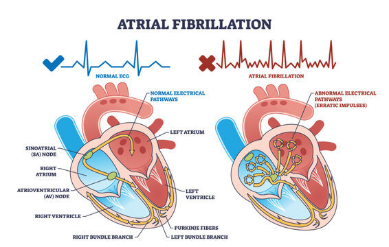 Atrial Fibrillation Images – Browse 4,665 Stock Photos, Vectors, and ...
