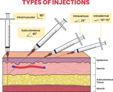 รูปภาพIntradermal – เลือกดูภาพถ่ายสต็อก เวกเตอร์ และวิดีโอ2,638 | Adobe ...