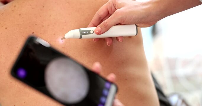 Dermatoscopy Images – Browse 2,350 Stock Photos, Vectors, and Video ...