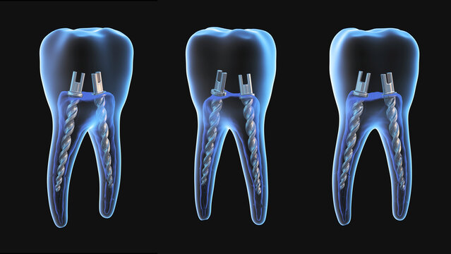 "Endodontic Treatment" Images – Browse 1,679 Stock Photos, Vectors, and ...