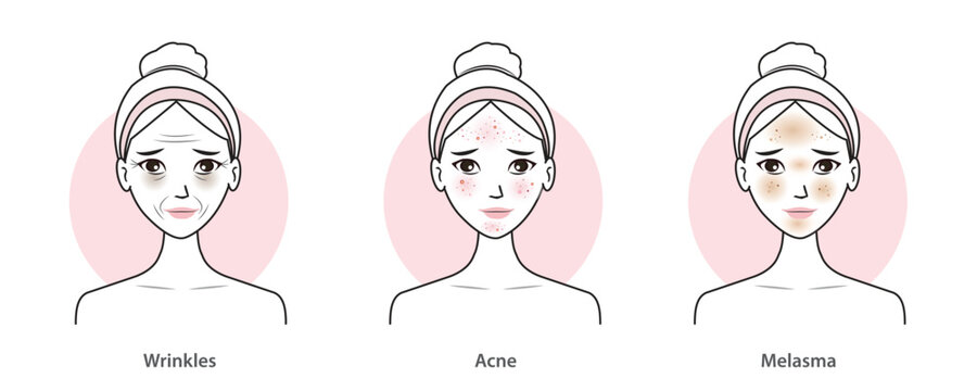 Hyperpigmentation Face Images – Browse 6,672 Stock Photos, Vectors, and ...