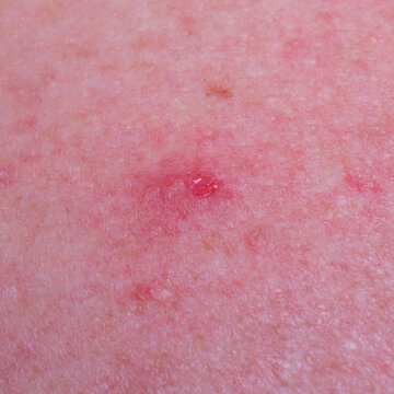 Basaliom-Bilder: Stock-Fotos & -Videos. | Adobe Stock