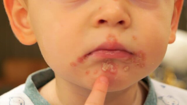 "Bacterial Skin Infection" Images – Browse 1,810 Stock Photos, Vectors ...