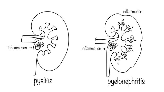 Pyelitis Images – Browse 36 Stock Photos, Vectors, and Video | Adobe Stock