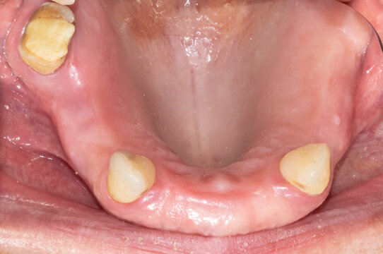 Occlusal Images – Browse 1,060 Stock Photos, Vectors, and Video | Adobe ...