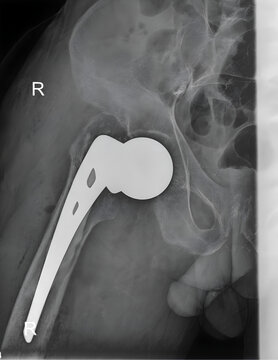 "Hip Replacement"-Bilder: Stock-Fotos & -Videos. | Adobe Stock