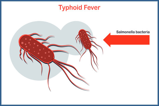 "Typhoid Fever" Images – Browse 2,581 Stock Photos, Vectors, and Video ...