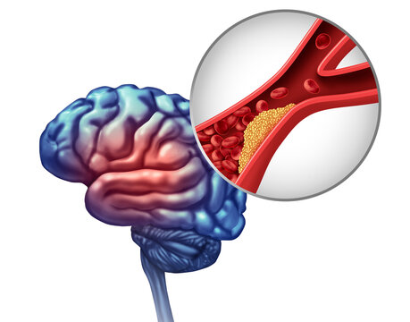 "Transient Ischemic Attack" Images – Browse 1,879 Stock Photos, Vectors ...