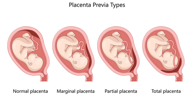 Placenta Images – Browse 13,992 Stock Photos, Vectors, and Video ...