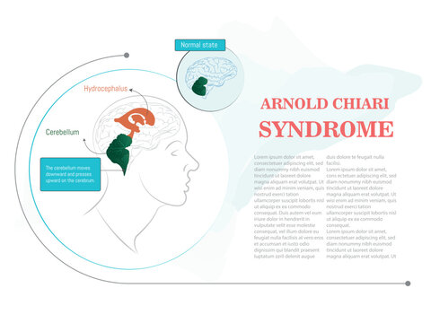 "Arnold Chiari Malformation" Images – Browse 561 Stock Photos, Vectors ...