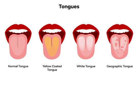 "White Tongue" Images – Browse 213 Stock Photos, Vectors, and Video ...