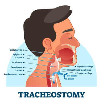 "Tracheostomy Tube" Images – Browse 1,328 Stock Photos, Vectors, and ...