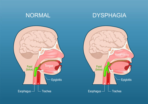 Epiglottis Diagram