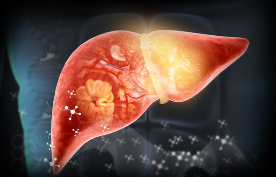 "Liver Cancer" Images – Browse 5,107 Stock Photos, Vectors, and Video ...