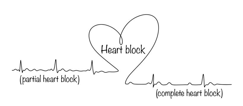 "Complete Heart Block" Images – Browse 21 Stock Photos, Vectors, and ...