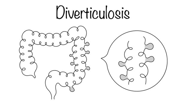 Imágenes de Diverticulosis: descubre bancos de fotos, ilustraciones ...