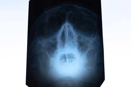 Deviated Septum X Ray