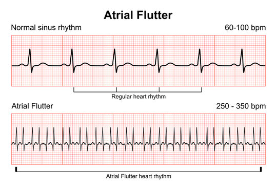 "Heart Rhythm" Images – Browse 10,755 Stock Photos, Vectors, and Video ...