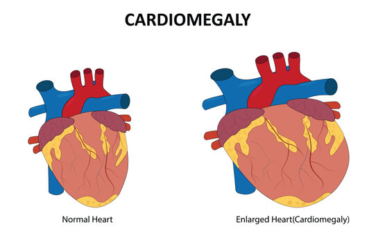 How Large Is An Enlarged Heart