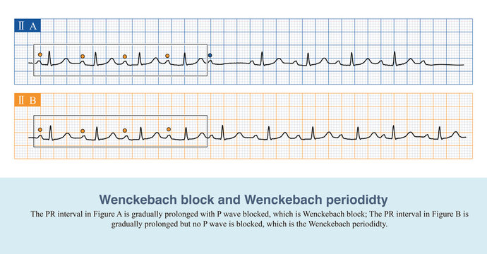 Wenckebach Images – Browse 49 Stock Photos, Vectors, and Video | Adobe ...