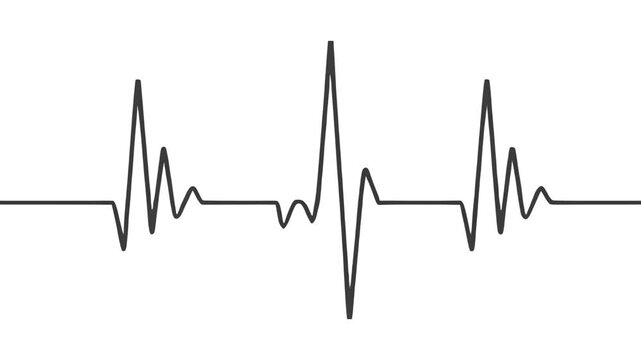 irregular heartbeat graph